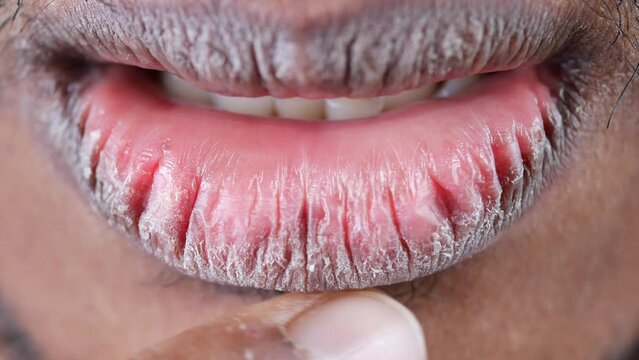 Causes Of Chapped Lips & How To Care For Your Lips - Kanda