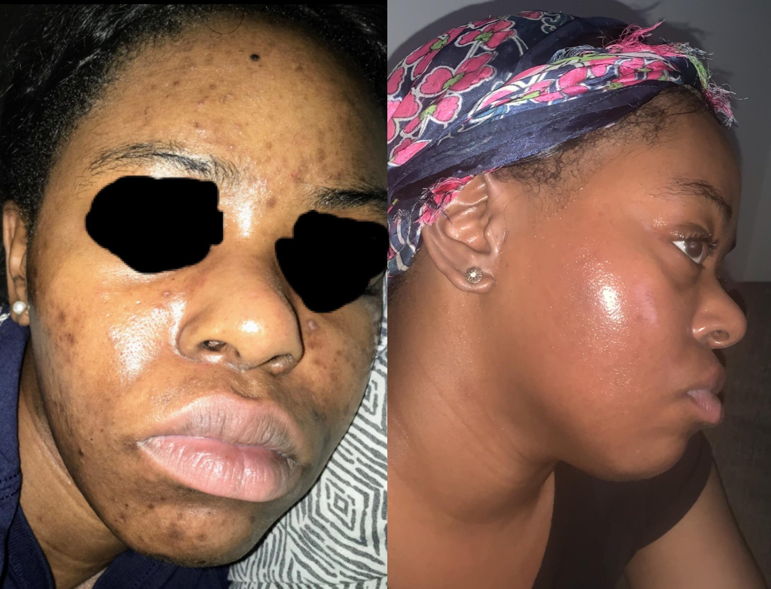 Uneven skin tone on face store